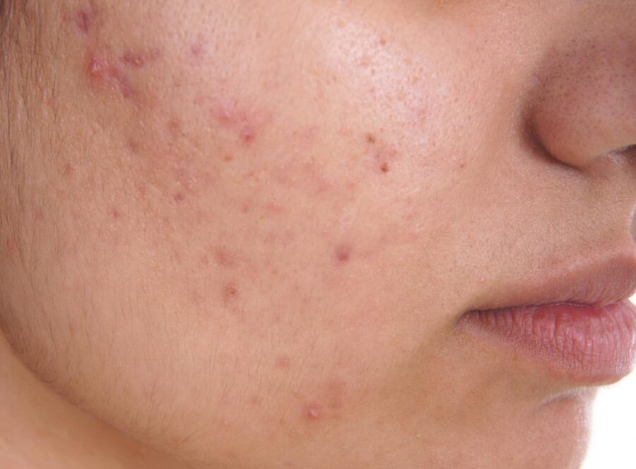 Acne - Eczema and Psoriasis Clinic Sydney